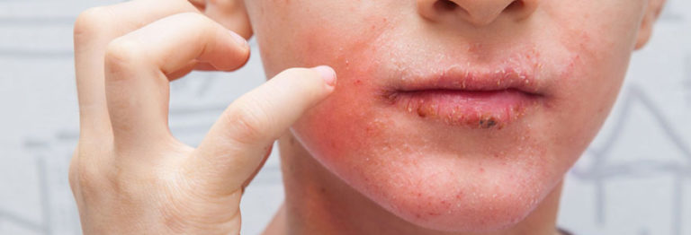 Le psoriasis du visage et son traitement.